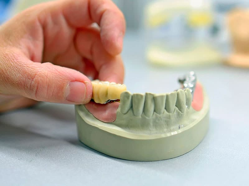 Implant Solutions. Crowns, Bridges, Captek, Veneers